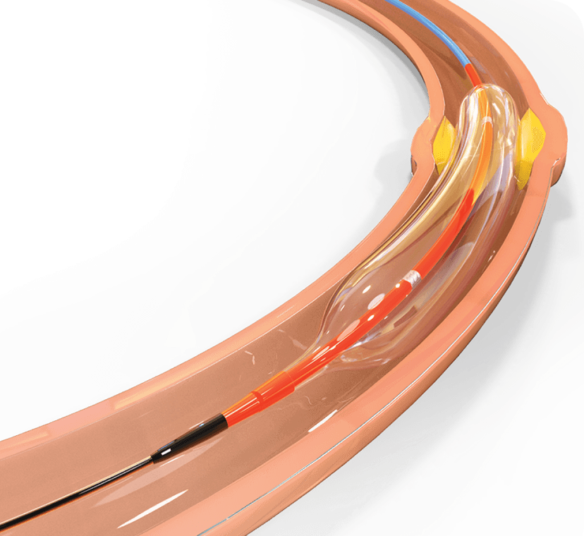 Advaglide PTCA Semi-Compliant Balloon | AMS